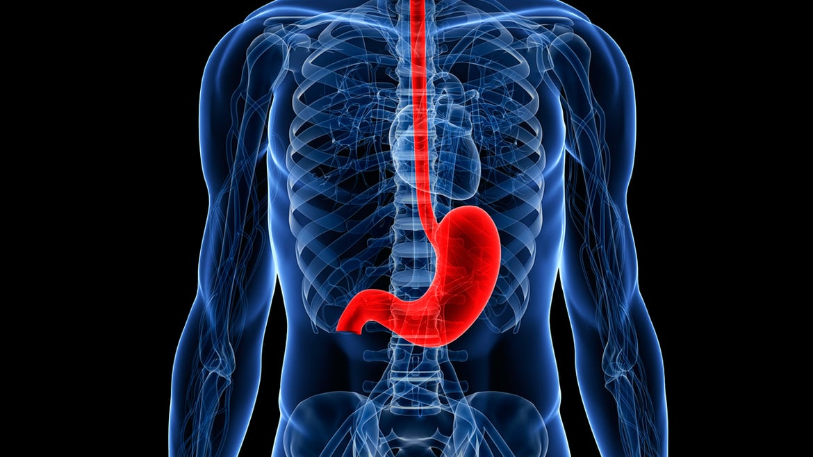 Cáncer de Estómago: Síntomas, Causas y Tratamiento